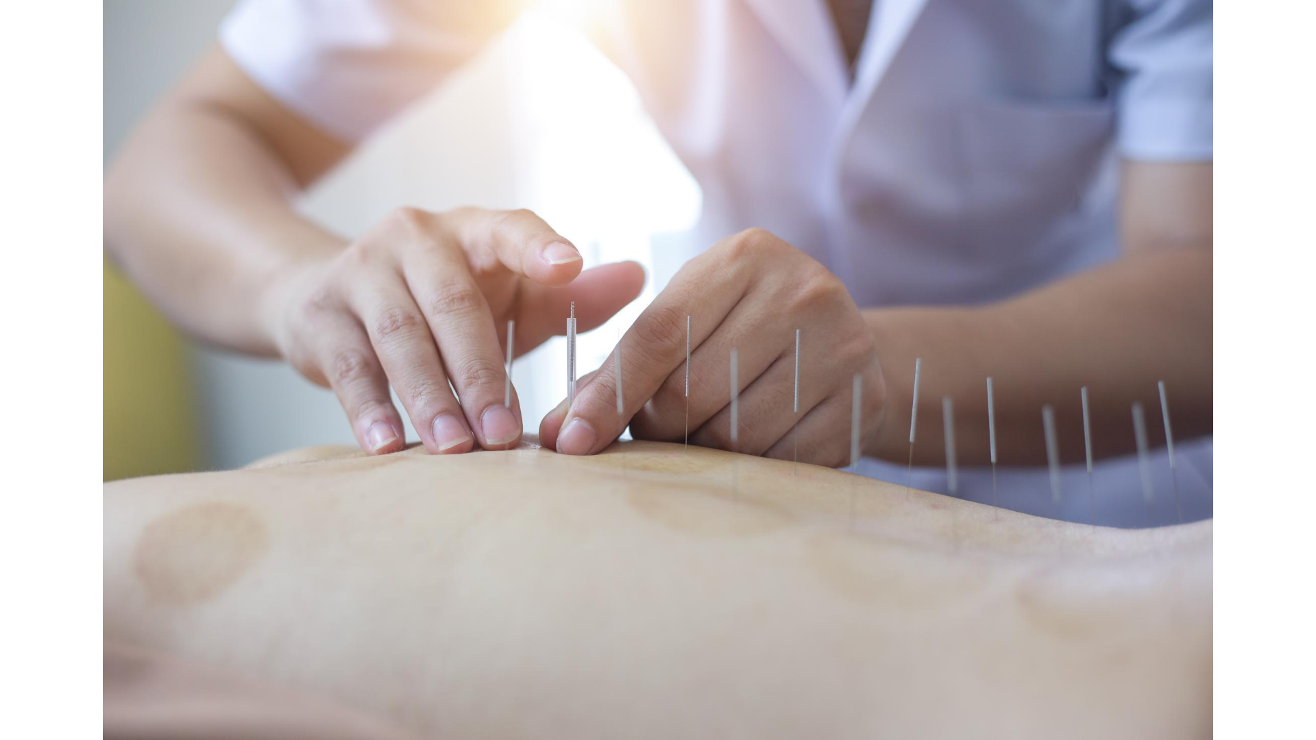 What Is Acupuncture? - Synergy Health Partners